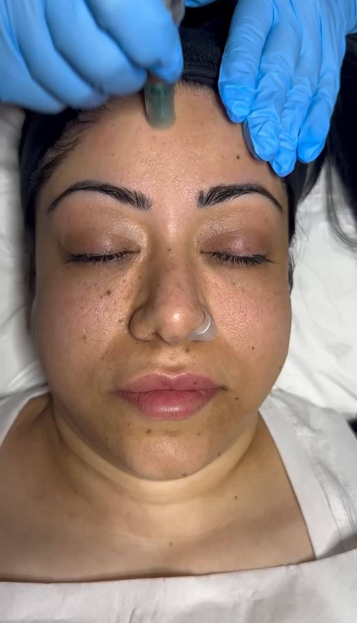 Skin Needling Benefits & Treatment Guide | Aesthetics Central